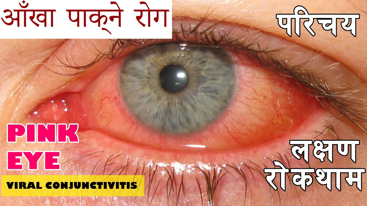 आँखा पाक्ने रोग ~ Pink Eye ~ Viral Conjuctivitis ~ Eye Flu ~ Jessica ...