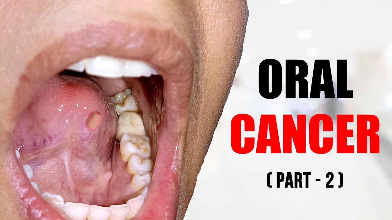 Oral Cancer ( Mouth Cancer ) | How to Check Oral Cancer | Part - 2 ...