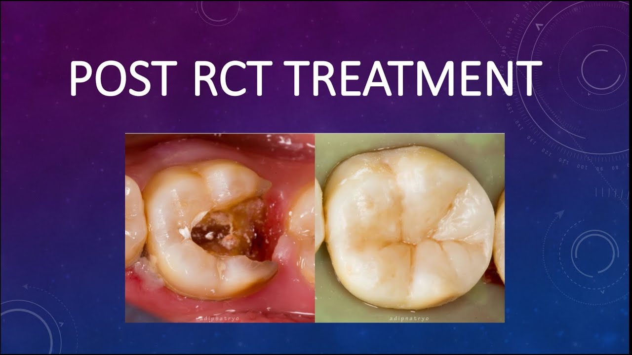 POST RCT TREATMENT - YouTube