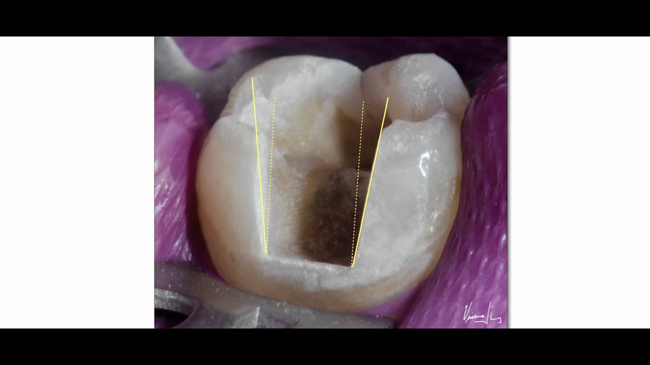 Casos Clínicos - Inlays e Onlays - YouTube