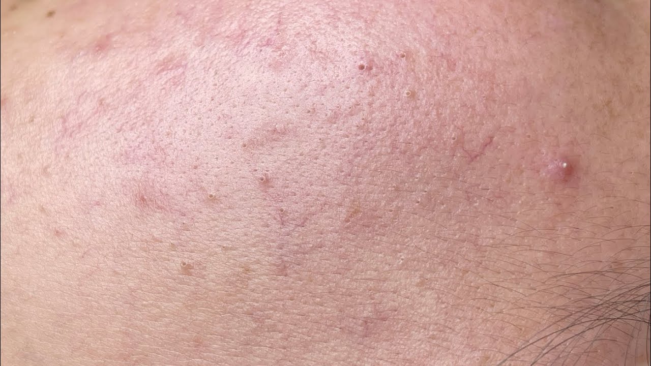 Most Satisfying Pimple Popping Ever #555 P2 - YouTube