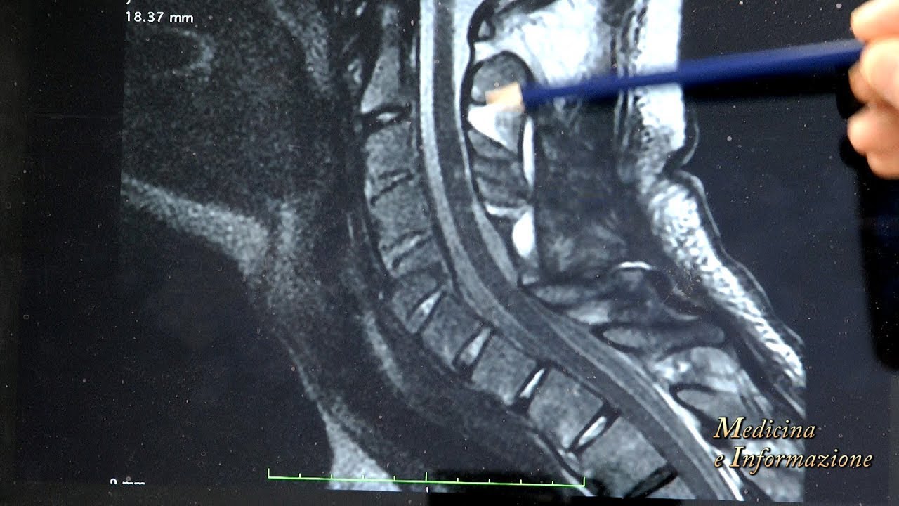 Dolore Cervicale: le cause, terapie conservative e tecniche chirurgiche ...