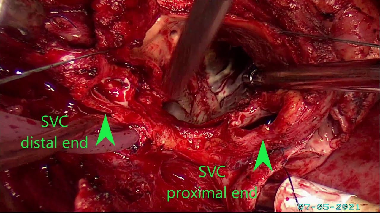 Re-Commando Procedure for Recurrent Endocarditis - YouTube