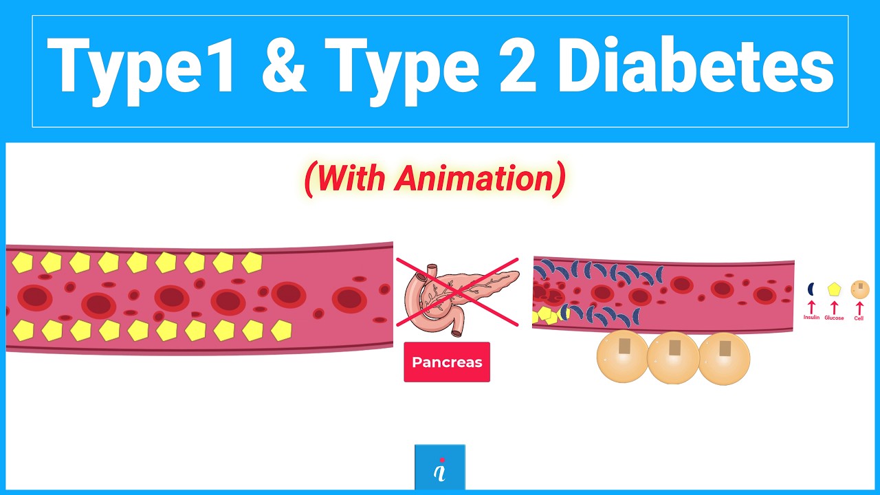 Type 1 and Type 2 Diabetes (Animation) - YouTube