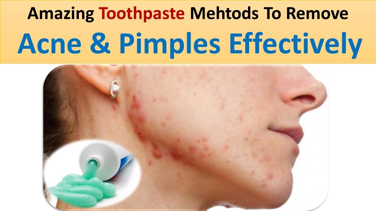 amazing Toothpaste Mehtods To Remove Acne & Pimples Effectively - YouTube
