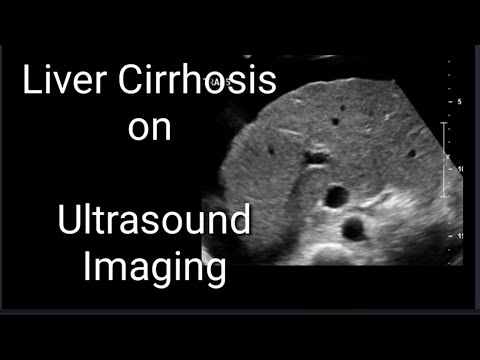 Sonographic Hallmarks of liver cirrhosis: coarse echotexture and ...