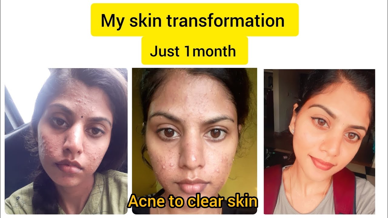 My skin transformation|ഇതൊക്കെ ശ്രദ്ധിച്ചില്ലെങ്കിൽ skin damage ആകും ...