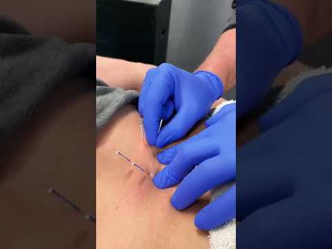 Where Do Acupuncture Needles Go For Lower Back Pain