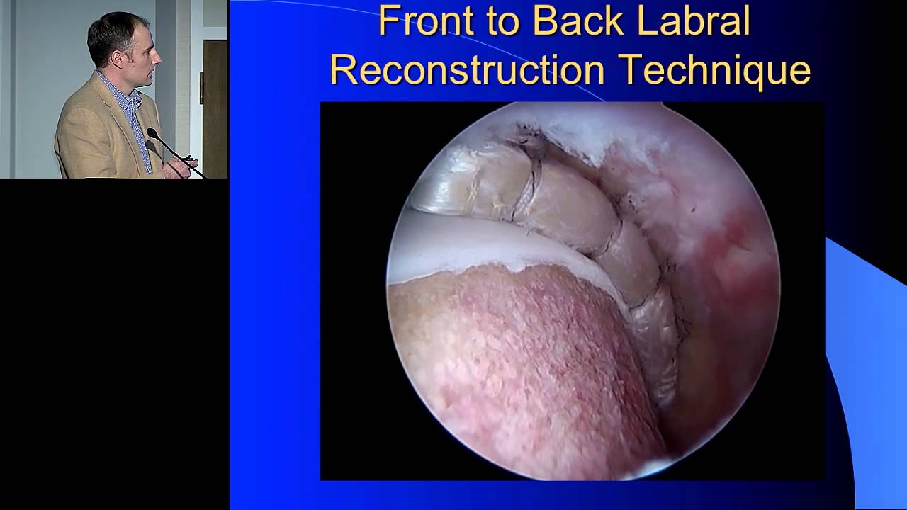 Brian J. White, MD talks about Labral Reconstruction - YouTube