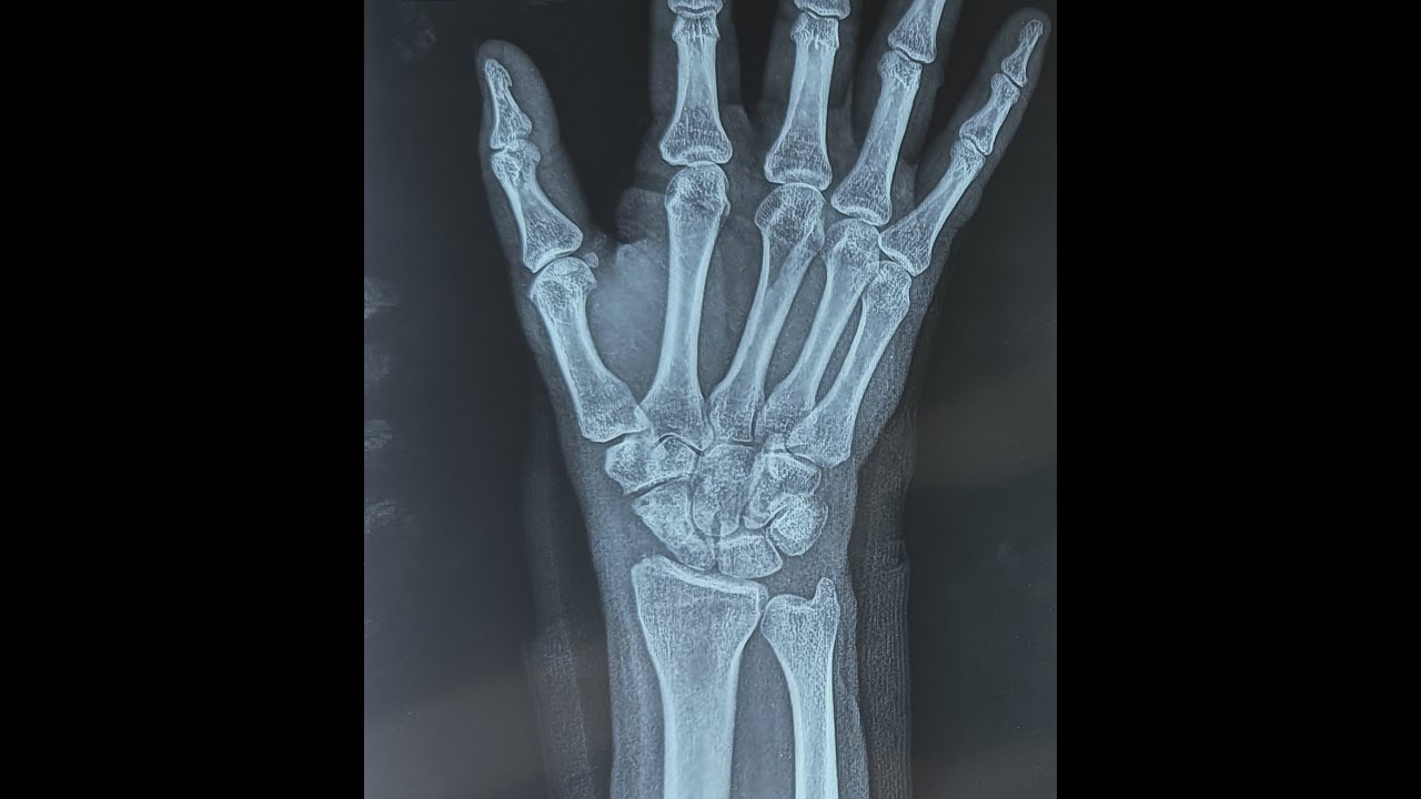 Radial styloidectomy / scaphoid non union / wrist pain / wrist ...