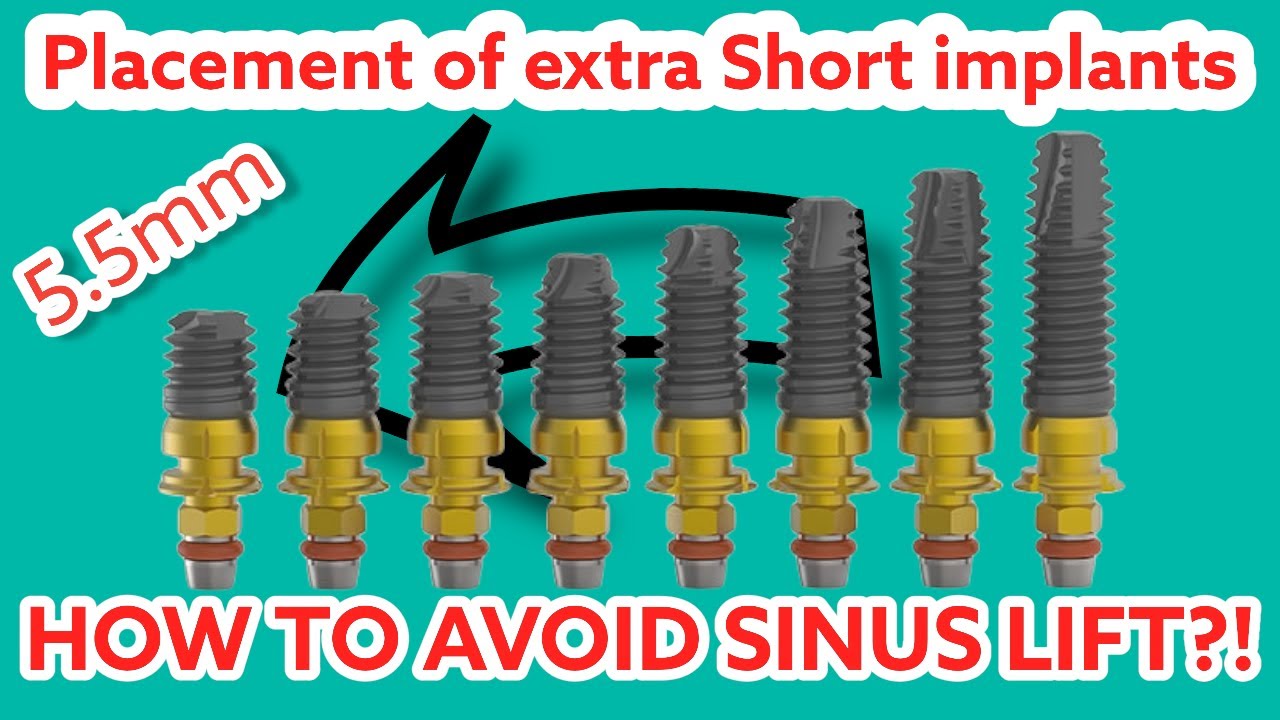 Placement of extra short dental implants with no sinus lift - YouTube