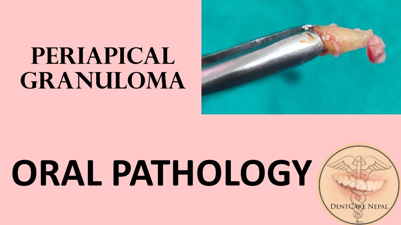 Periapical Granuloma Histology Odontogenic Keratocyst Wikipedia