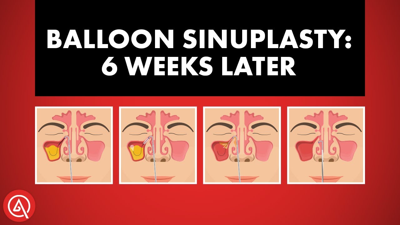 Andy's 6-week follow-up after his in-office Balloon Sinuplasty - YouTube