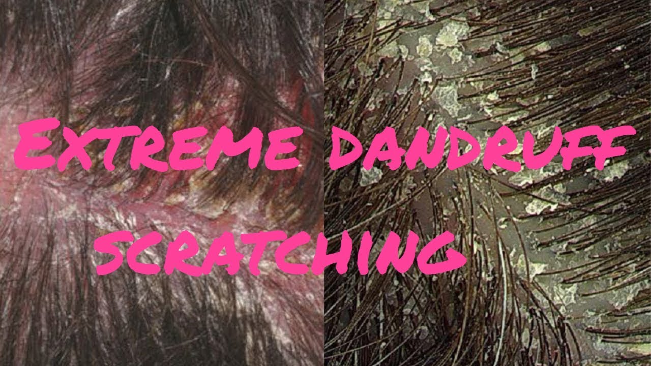 EXTREME DANDRUFF | SCRATCHING MY SCALP | SATISFYING DANDRUFF PICKING ...