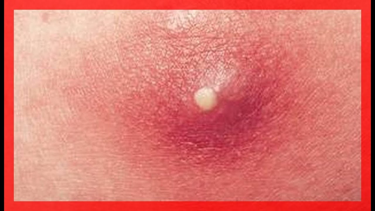 Los forúnculos o nacidos se pueden remediar con estas plantas naturales ...