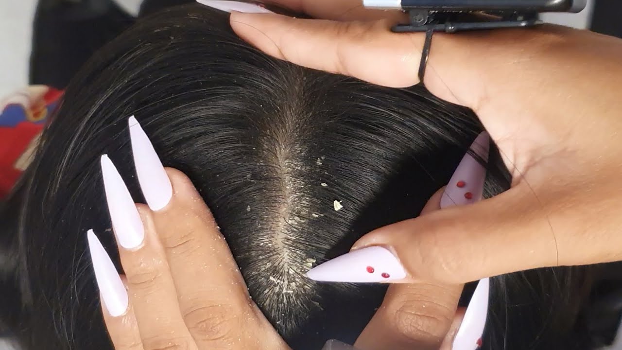 Relaxing Scalp Scratch Therapy ASMR 🌙 | Heavy Flakes, Slow Nails & Deep ...