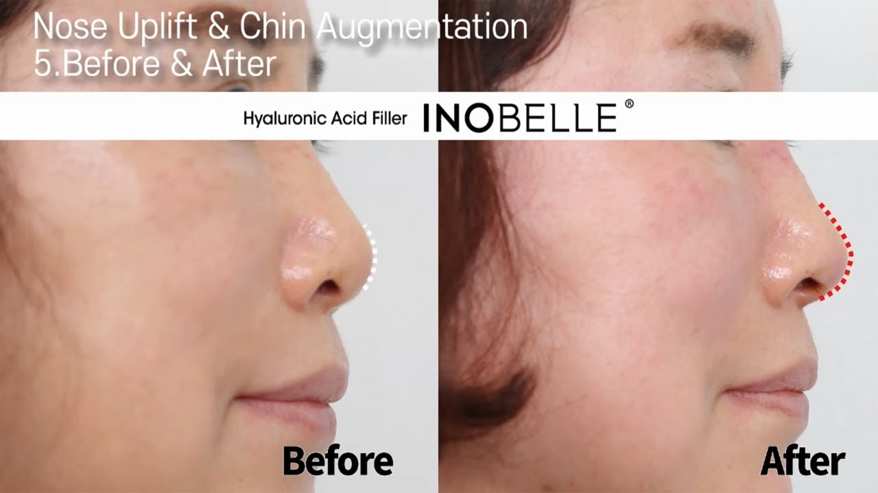 Nose Uplift by Inobelle - YouTube