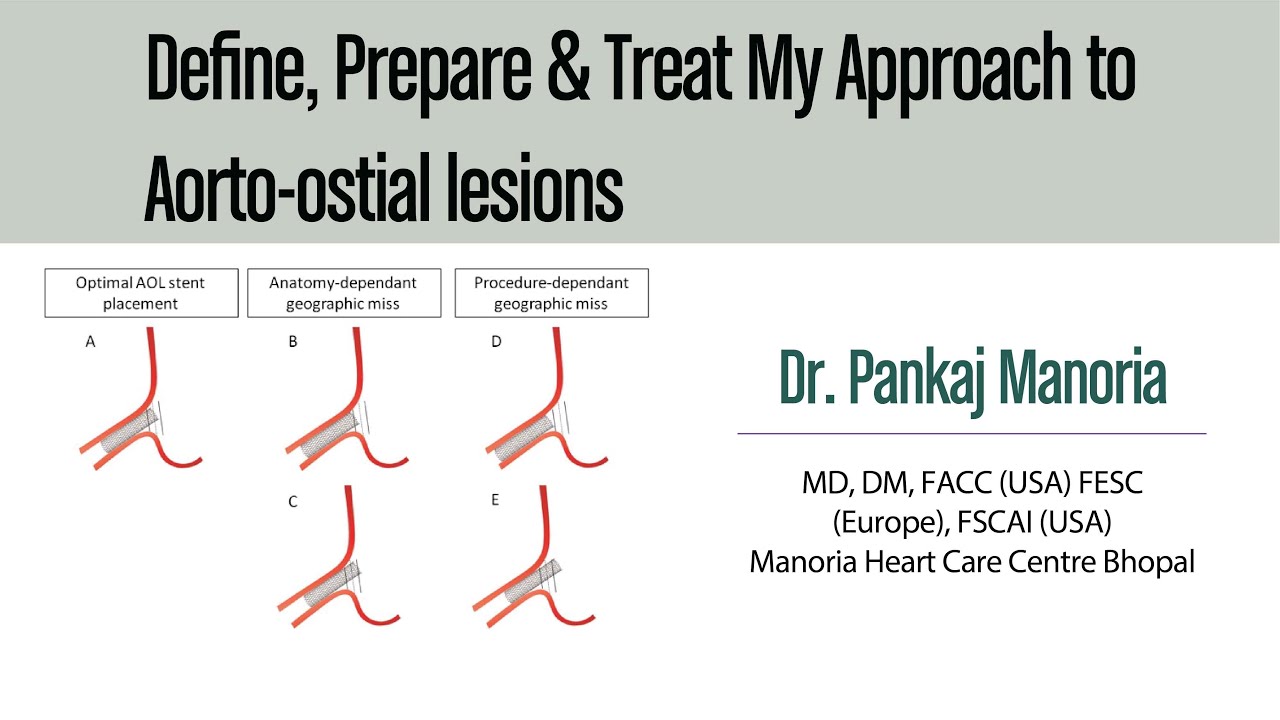 DEFINE, PREPARE & TREAT My Approach to Aorto-osteal lesion - YouTube