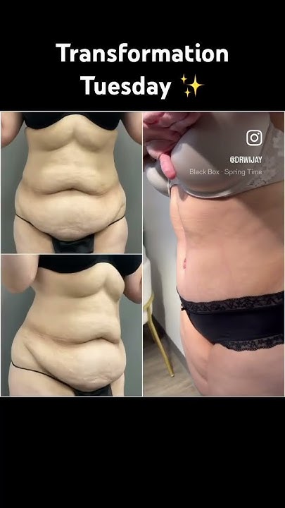 Tummy tuck transformation! - YouTube