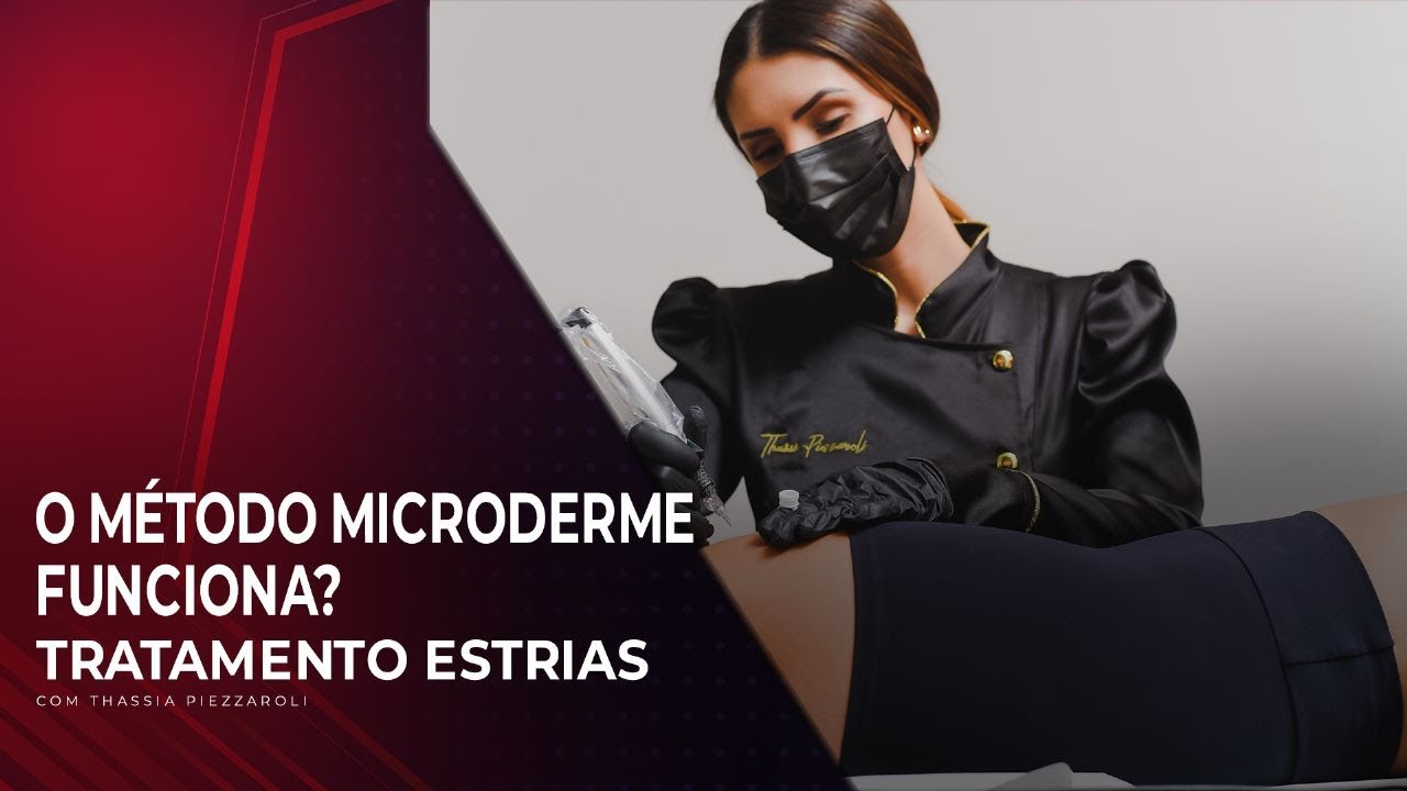 Como melhorar estrias largas e fundas? Método Microderme - YouTube