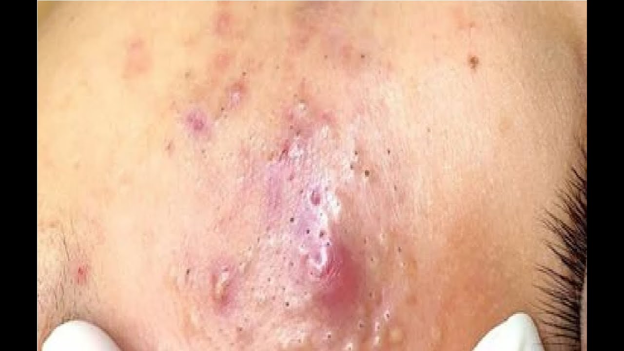 Satisfying And Relaxation with NaSa Beauty Spa #26 black point and acne ...