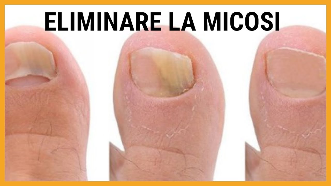Come ELIMINARE LA MICOSI dalle unghie ♡ - YouTube