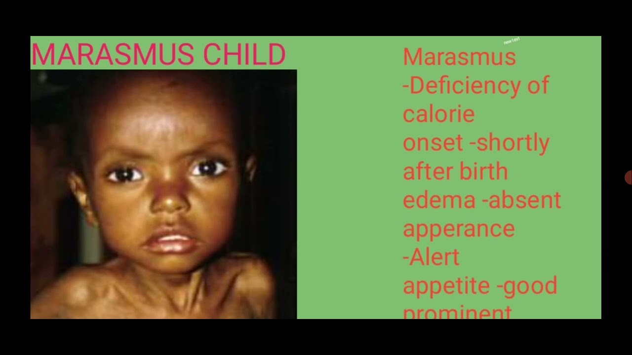 MARASMUS CHILD - YouTube