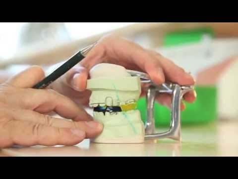 ORTODONCJA Twin Block - YouTube