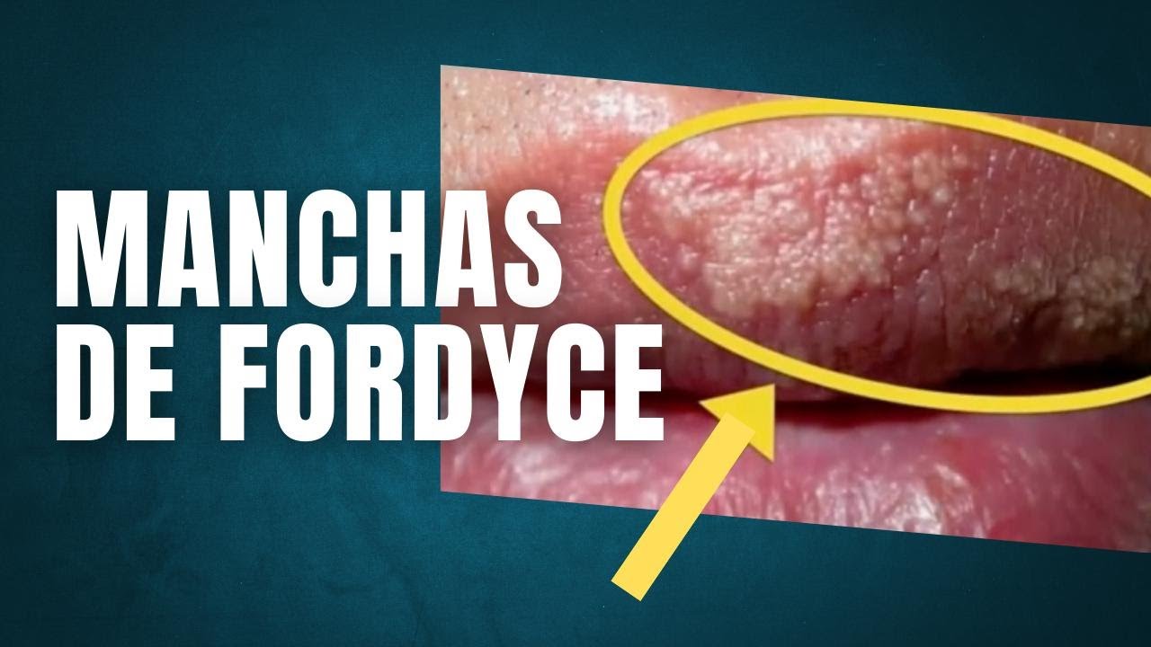 TENHO MANCHAS DE FORDYCE | DR. DAVID CAMPOS - YouTube