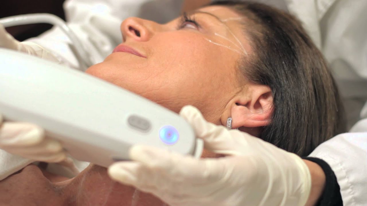 Ultherapy with Dr. Monica Perlman - YouTube