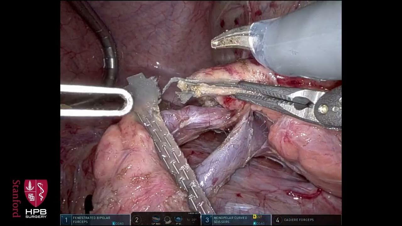 Robotic Spleen Preserving Distal Pancreatectomy (Kimura technique) - YouTube