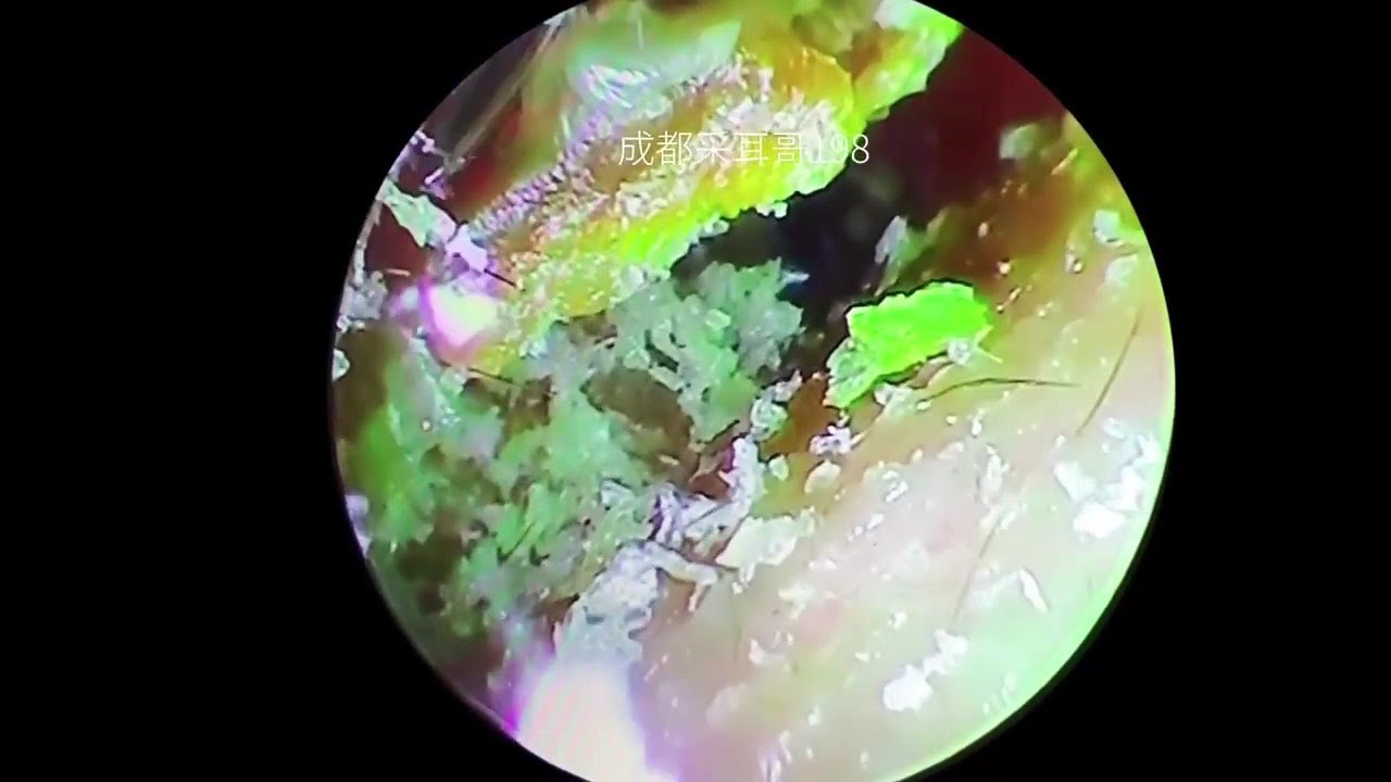 Relax Everyday With Satisfying Ear Wax Removal #040 - YouTube