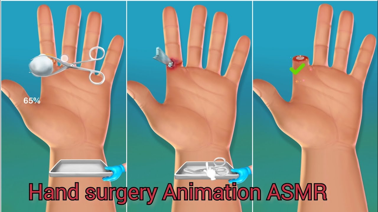 Hand surgery/ Doctor ASMR/ satisfying ASMR/ relaxing ASMR / Animation ...