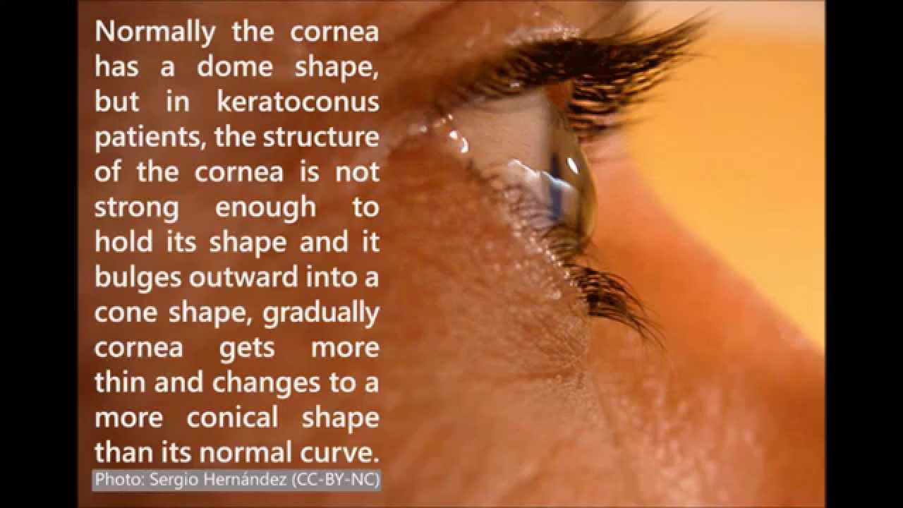 Keratoconus - YouTube