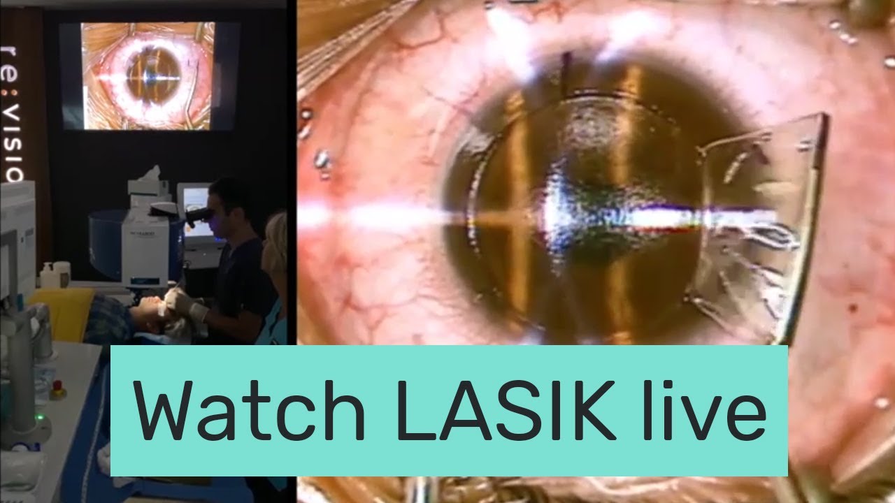 Watch LASIK Live Surgery | Re:Vision - YouTube