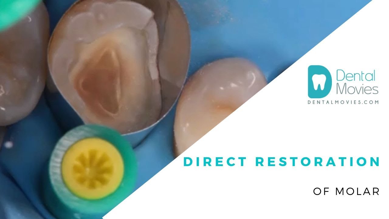 Direct restoration of molar - YouTube