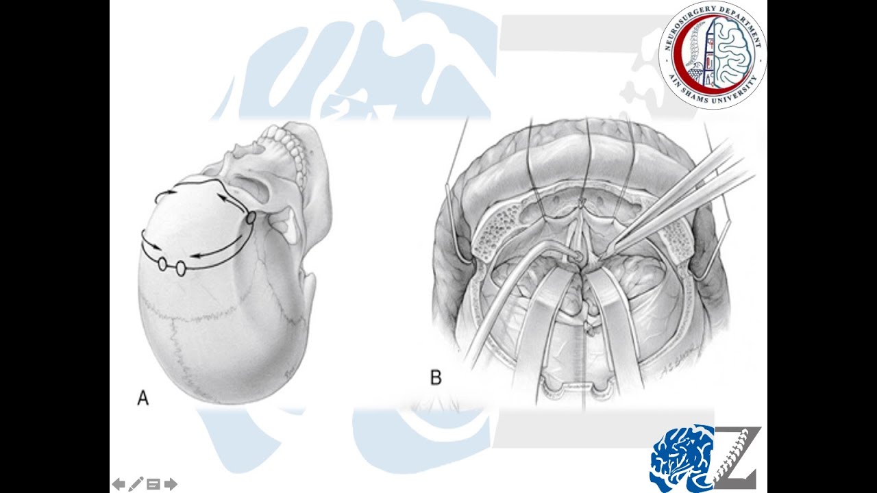 Cranial Approaches (4): Frontal Approaches - YouTube