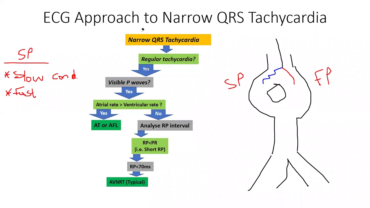 APPROACH TO NARROW QRS TACHYCARDIA - YouTube