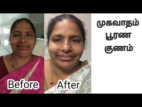 Facial Palsy | முகவாதம் | Siddha Treatment | Varmam Treatment | Dr ...