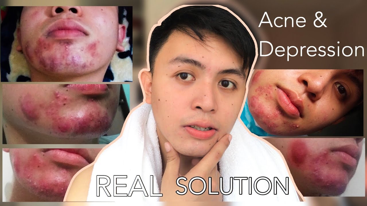 ANG TOTOONG SOLUSYON! Paano Nawala ang Pimples Ko STOP ACNE NOW - YouTube