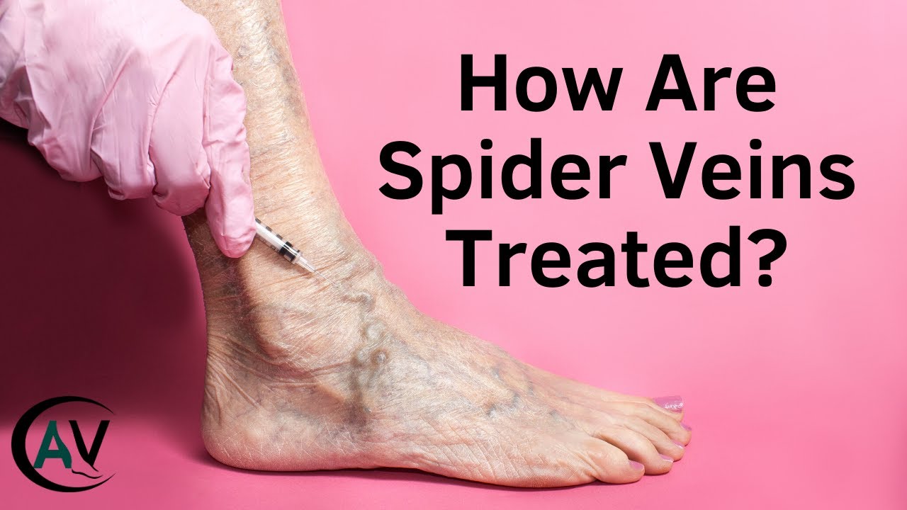 How Are Spider Veins Treated Youtube