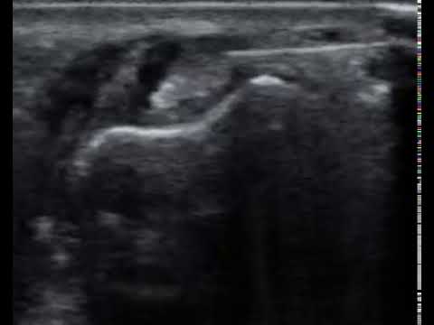 Ultrasound Guided Injection for Stenosing Tenosynovitis of the Extensor ...