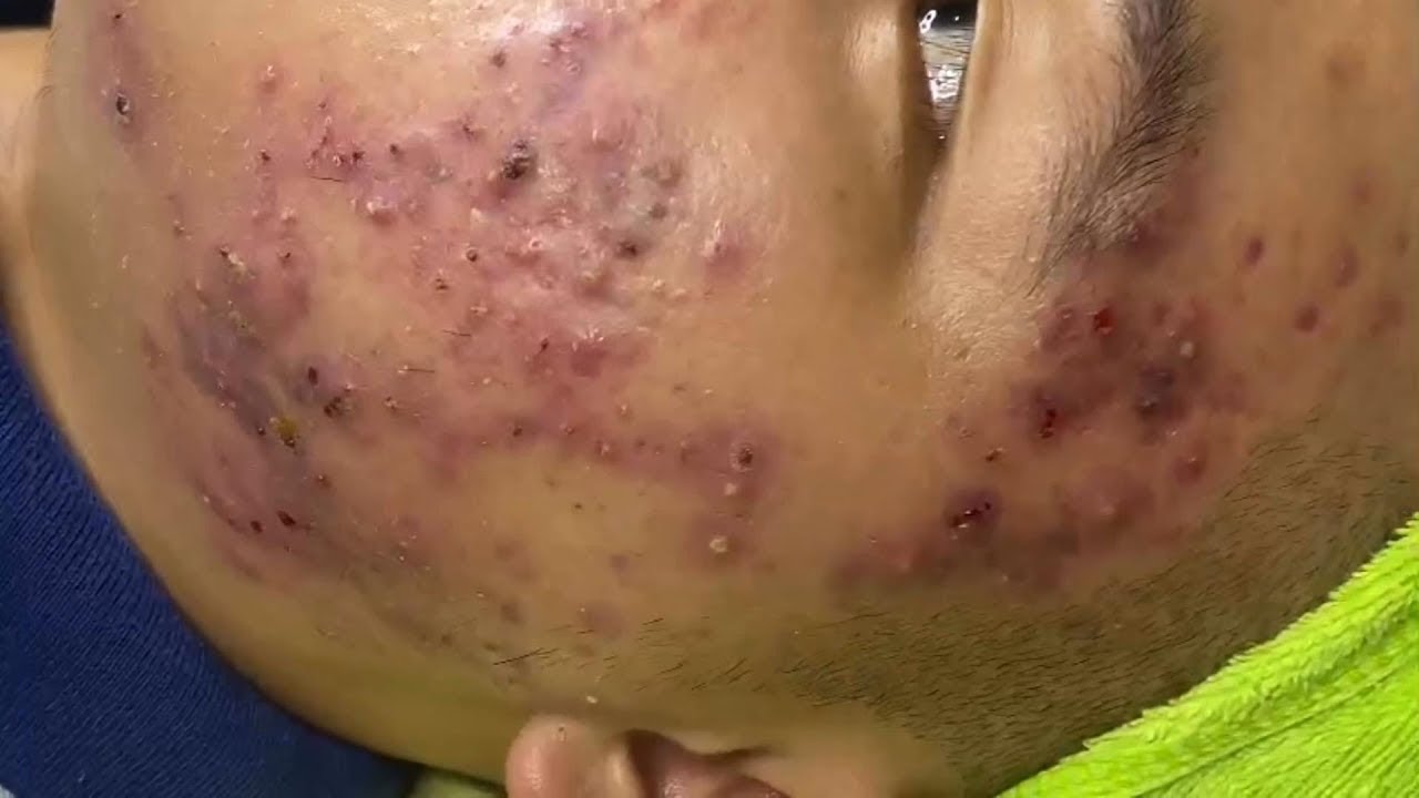 Big Cystic Acne Blackheads Extraction Blackheads & Milia, Whiteheads ...