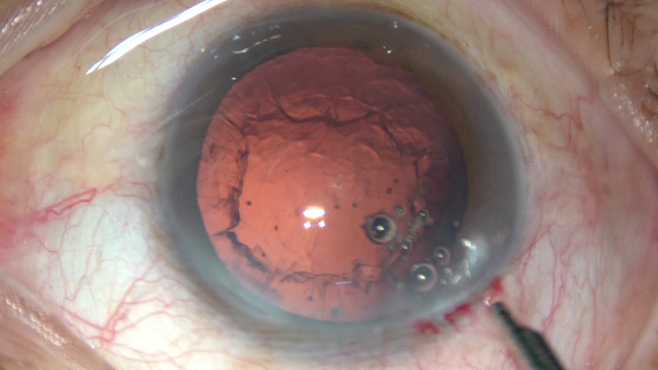 Routine Phaco by DIRECT CHOP in 5 minutes - swift and safe surgery ...