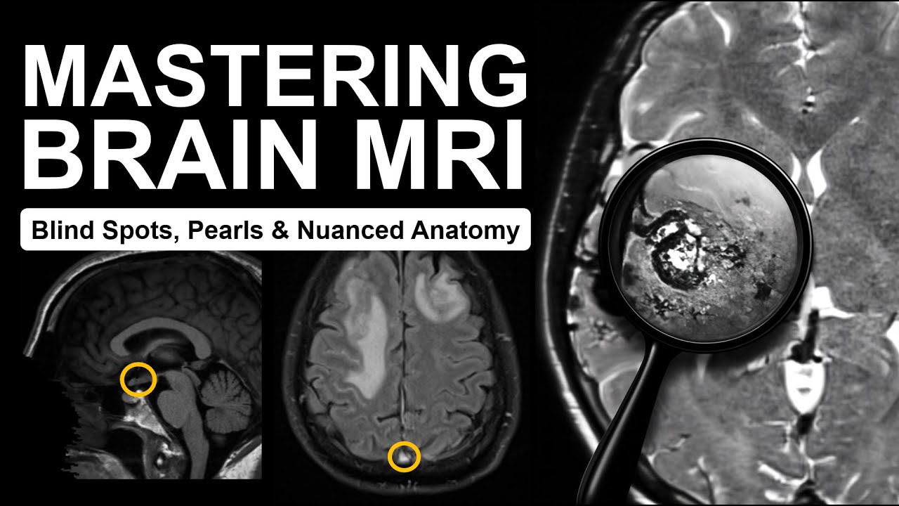 Mastering Brain MRI: Blind Spots, Pearls & Nuanced Anatomy - YouTube