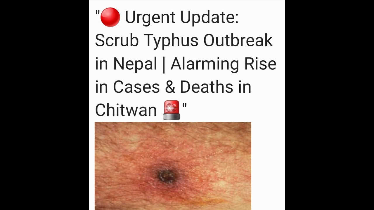 "🔴 Urgent Update: Scrub Typhus Outbreak in Nepal | Alarming Rise in Cases & Deaths in Chitwan 😷🚨 ...