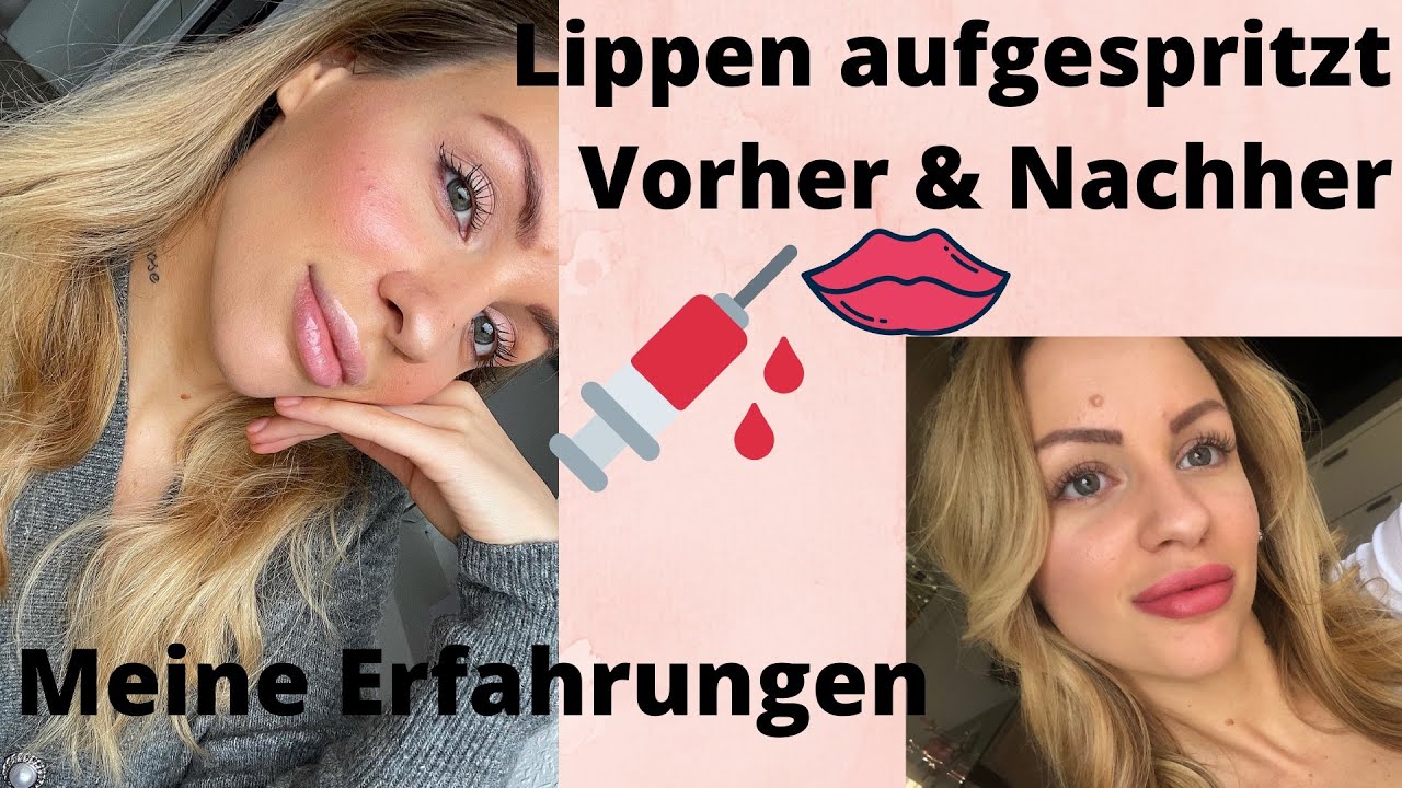 Fabelhafte Aufgespritzte Lippen Extrem Bild