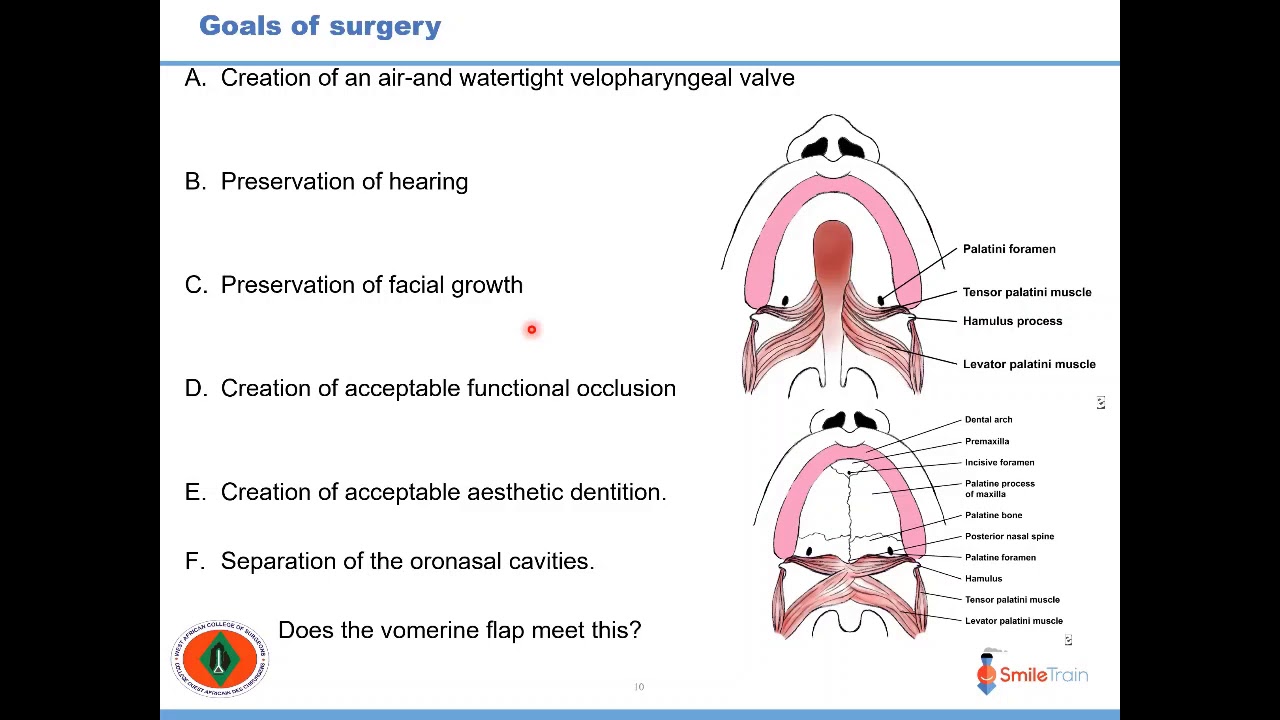 The Use of Vomer Flap in Palatal Surgery | Prof. Sunday O Ajike | 24 ...