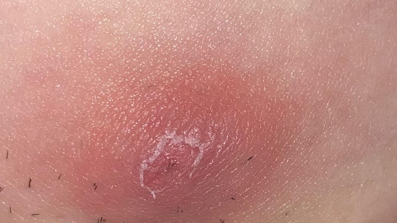 how to get rid of an ingrown hair cyst under your arm easy - YouTube