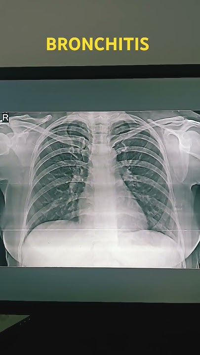 Xray Chest pa Bronchitis BVM- - YouTube